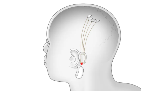 First Patient Receives Brain Implant From Musks Neuralink Techcentral Ie